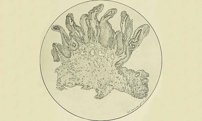 Condyloma Acuminata - verrugas genitales | Dermatólogo Contour